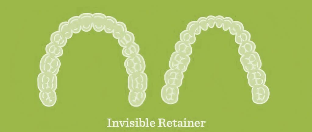 Dental Retainers in Spokane, WA | DaBell & Paventy Orthodontics ...